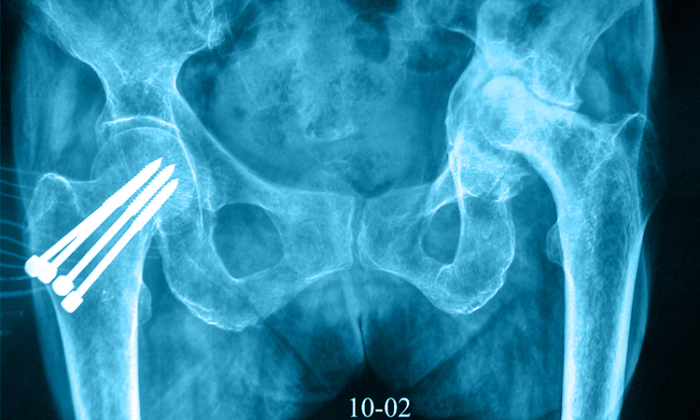 Dr. Carlos Godoy | Fractura de Cadera