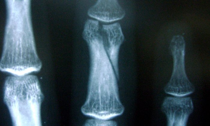 Dr. Carlos Godoy | Fracturas de falanges y metacarpianos en la mano