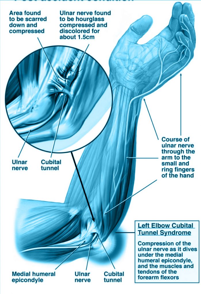 Dr. Carlos Godoy | Lesión por compresión del nervio cubital