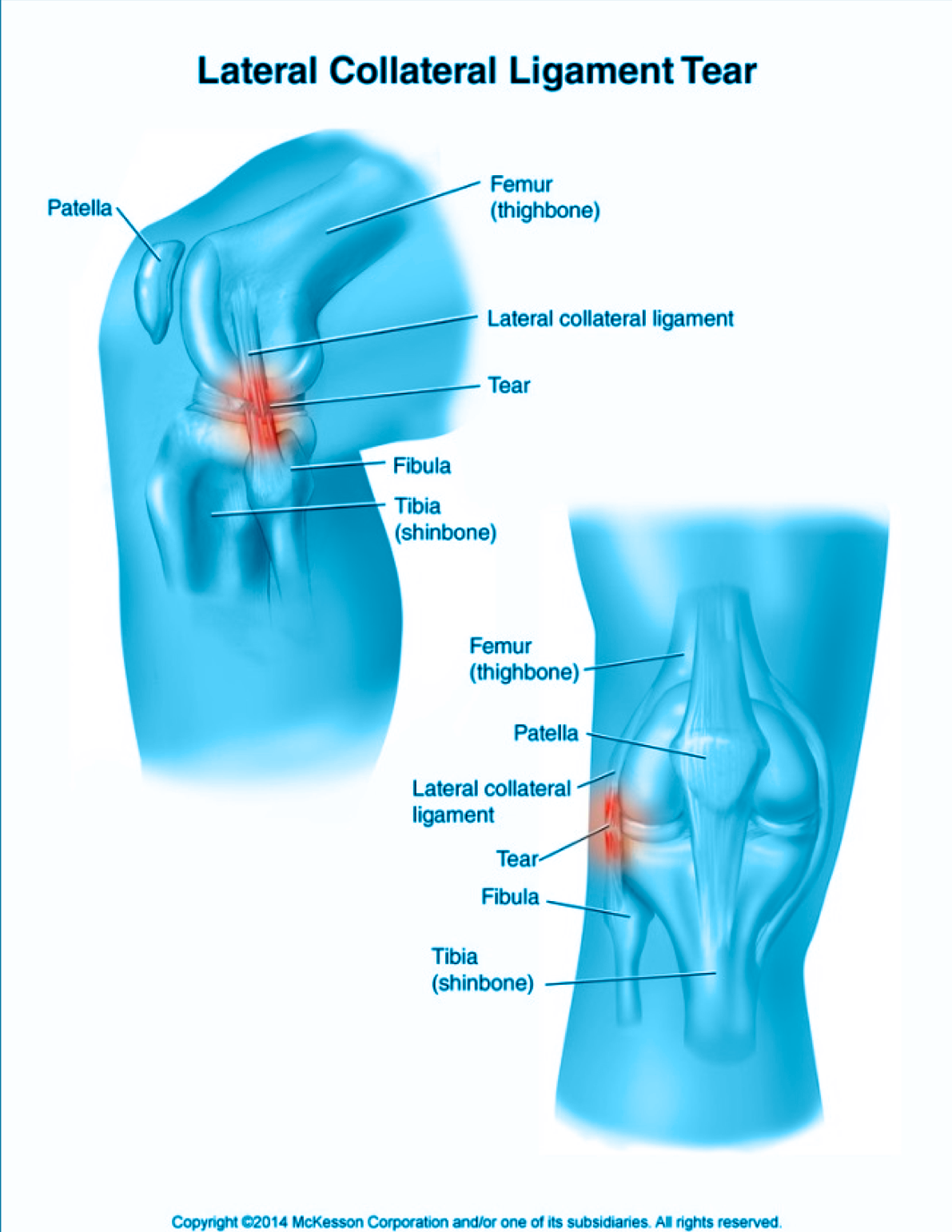 Dr. Carlos Godoy | Lesión de Ligamentos Colaterales de la Rodilla Dr. Carlos Godoy | Lesión de Ligamentos Colaterales de la Rodilla